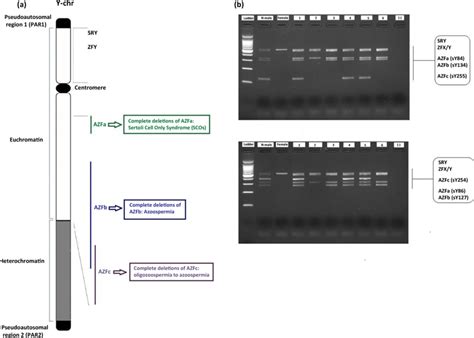 Y Chromosome Microdeletion Testing A Schematic Diagram Of Human Y