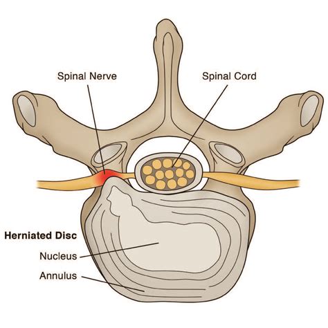 Lumbar Disc Herniation Massage And Chiropractic