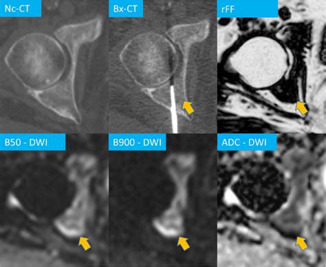 Multiparametric Mri Of A Right Acetabulum Metastasis In A 60 Year Old Download Scientific