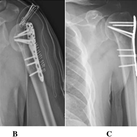 A Year Old Woman With A Fracture Of The Proximal Humerus After A Download Scientific Diagram