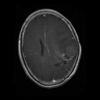 Labeled MRI Brain Tumor Dataset Object Detection Dataset And Pre Trained Model By Ali Rostami