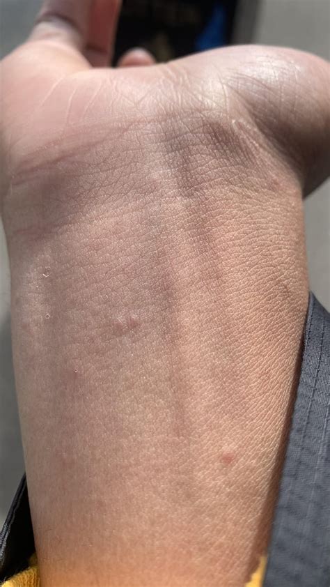 Weird Inconsistent Rash On Hands What Is It And How To Get Rid Of It