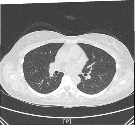 폐ct 판독부탁드립니다 감사합니다 궁금할 땐 아하