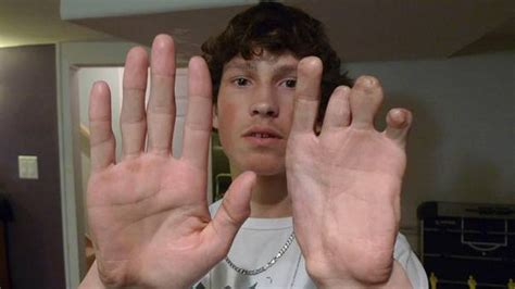 How Accurate Is The FibroScan Test Quora