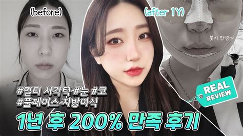 성형브이로그 아현이의 👉윤곽수술 지방이식 코성형 윗트임👈 1년 차 후기 자연스럽게 더 예뻐진 썰 푼다💖💖 지방이식 사각턱수술 코성형 윗트임 Youtube