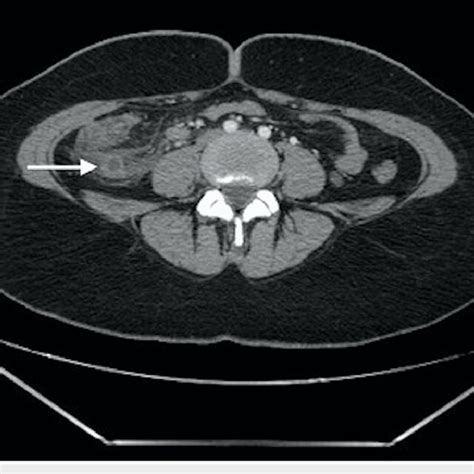 Axial Ct Scan Showing Swollen Appendix Surrounded By Mesenteric Fat
