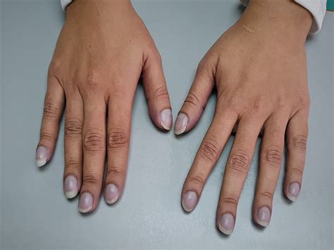Cardiac Causes Of Clubbing Causes Of Finger Clubbing Youtube