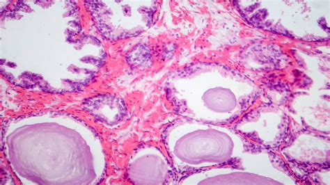 Gutartige Prostatavergrößerung Urologenzentrum Wien