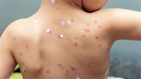 Combatting Measles Expert Explains Symptoms And Effective Prevention Strategies Onlymyhealth