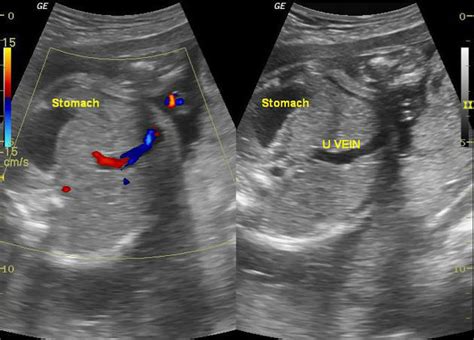 Umbilical Cord Abnormalities Pacs