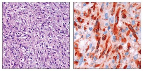 Inflammatory Pseudotumor Basicmedical Key