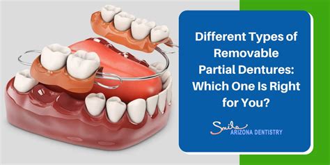 Different Types Of Removable Partial Dentures Which One Is Right For You