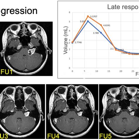 A Longitudinal Follow Up Model Of Vestibular Schwannoma Created By