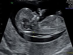 Nuchal Translucency And Nasal Bone Assessments Level Ii Ultrasound