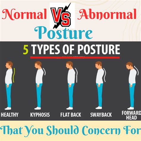 Four Types Of Postural Alignment Flat Back Posture Alignment Therapy