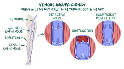 Venous Ulcer Diagram