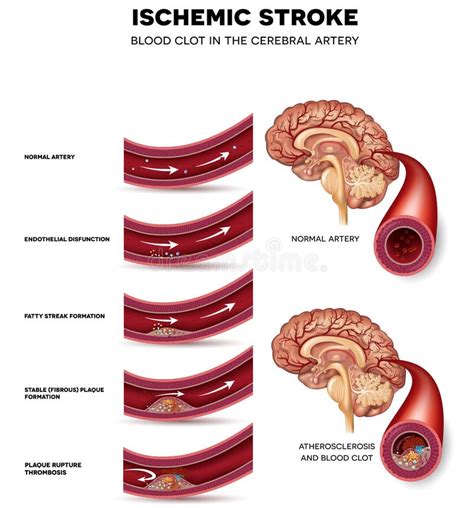 Brain Stroke Diagram Stock Illustrations 406 Brain Stroke Diagram