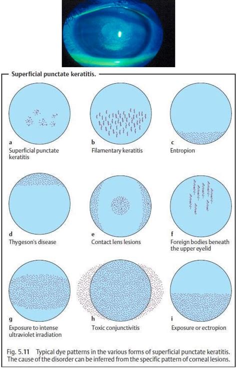 Punctate Epithelial Keratitis