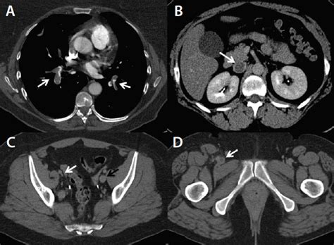 Endovascular Today Ct Venography Technique And Indications July 2018
