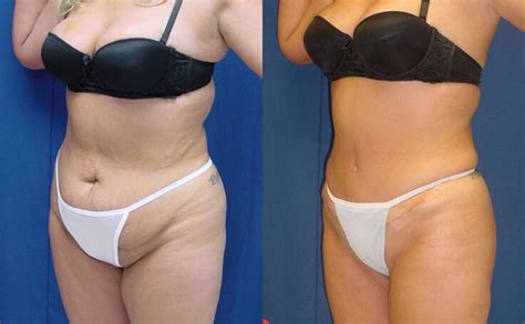 Tummy Tuck Before And After Stretch Marks