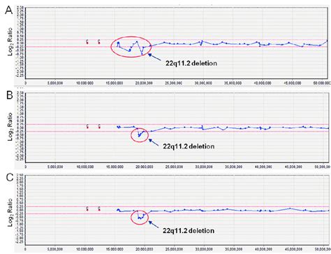 Array Cgh Profile From Chromosome 22 Shows A Deletion On The Long Arm