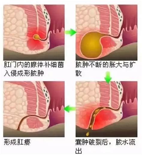 高位复杂肛瘘好治吗 大理肛泰医院治高位肛瘘可以吗 哔哩哔哩