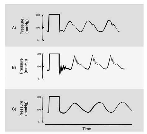 Level Of Transducer For Arterial Line At James Urbina Blog