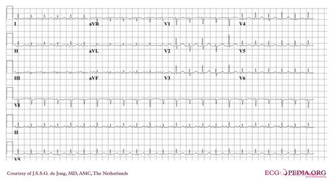 Answer Case Of The Month Aug 2012 ECGpedia