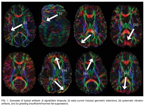 Dti Quality Control Part 4 Further Reading Diffusion Imaging
