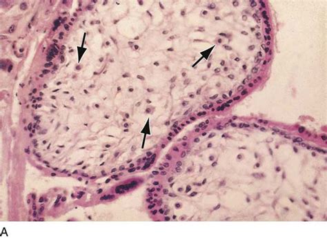 Trophoblastic Disease Obgyn Key