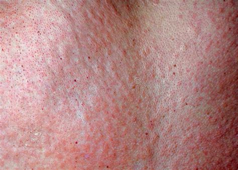 Psoriasis Dermatitis Problem Of Rash And Itchy Dry Skin Stock Image