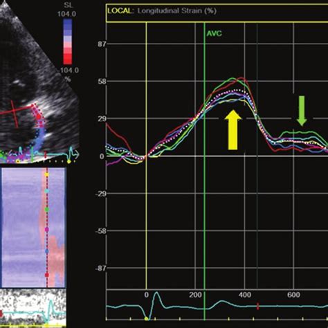 Example Of Left Atrium Two Dimensional Speckle Tracking Download