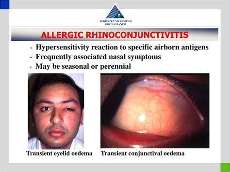 Ppt Disorders Of The Conjunctiva And Cornea Powerpoint Presentation