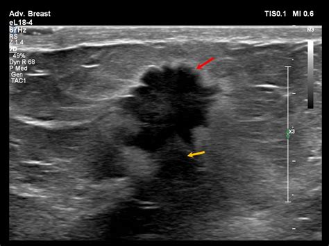 Atlas Of Breast Cancer Early Detection