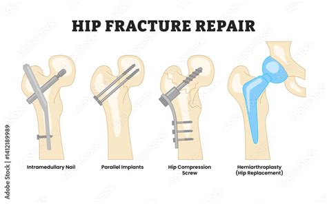 Different Types Of Hip Fracture Repair Types Educational Medical Poster Design Healthcare