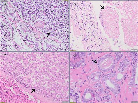 A Metastatic Pulmonary Osteosarcoma Arrow Hande × 20 B Tumor