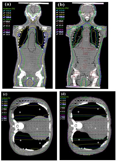 Analytical Anisotropic Algorithm Calculation In Total Body Irradiation A Comparison With Monte