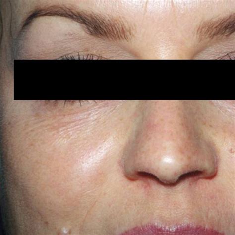 Hyperpigmentation Treatment Lookfresh