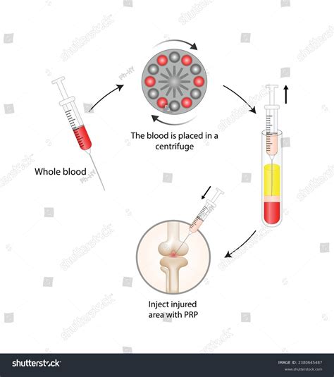 Platelet Rich Plasma Prp Autologous Conditioned Plasma Stock Vector Royalty Free 2380645487