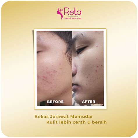 Before After Reta Beauty Clinic