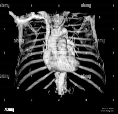 3D CT Reconstruction Of Heart Stock Photo Alamy