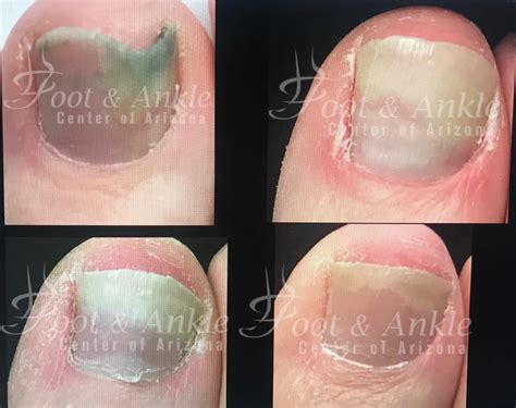 Toenail Fungus Treatment Laser Treatment For Toenail Fungus