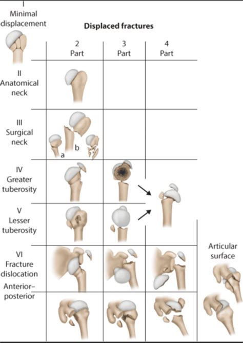 Proximal Humerus Fractures A Review Of Anatomy Classification