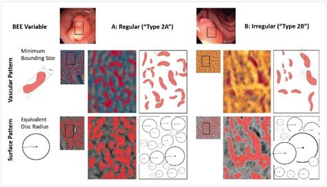 Bioinformatically Enhanced Endoscopy Bee Mathematical Analysis Of
