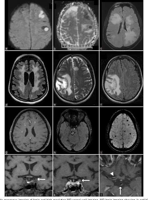 Figure 1 From Primary Angiitis Of The Central Nervous System