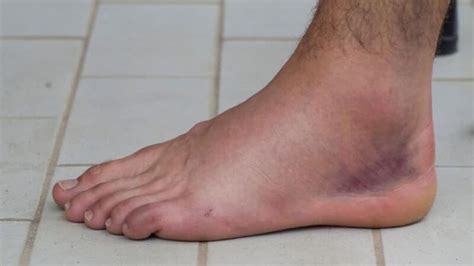 Sprained Ankle Symptoms And Causes Of Ankle Sprain Explained