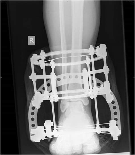 Calcaneal Intraosseous Lipoma Treated With External Fixation A Case Report And Review Of The