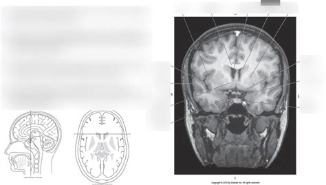 Coronal 1 Diagram Quizlet