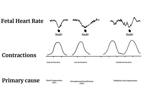 Fetal Heart Rate Monitoring And Veal Chop Mine In Nursing Nurseship