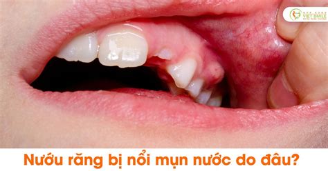 Nướu Răng Bị Nổi Mụn Nước Do đâu Phải Làm Sao